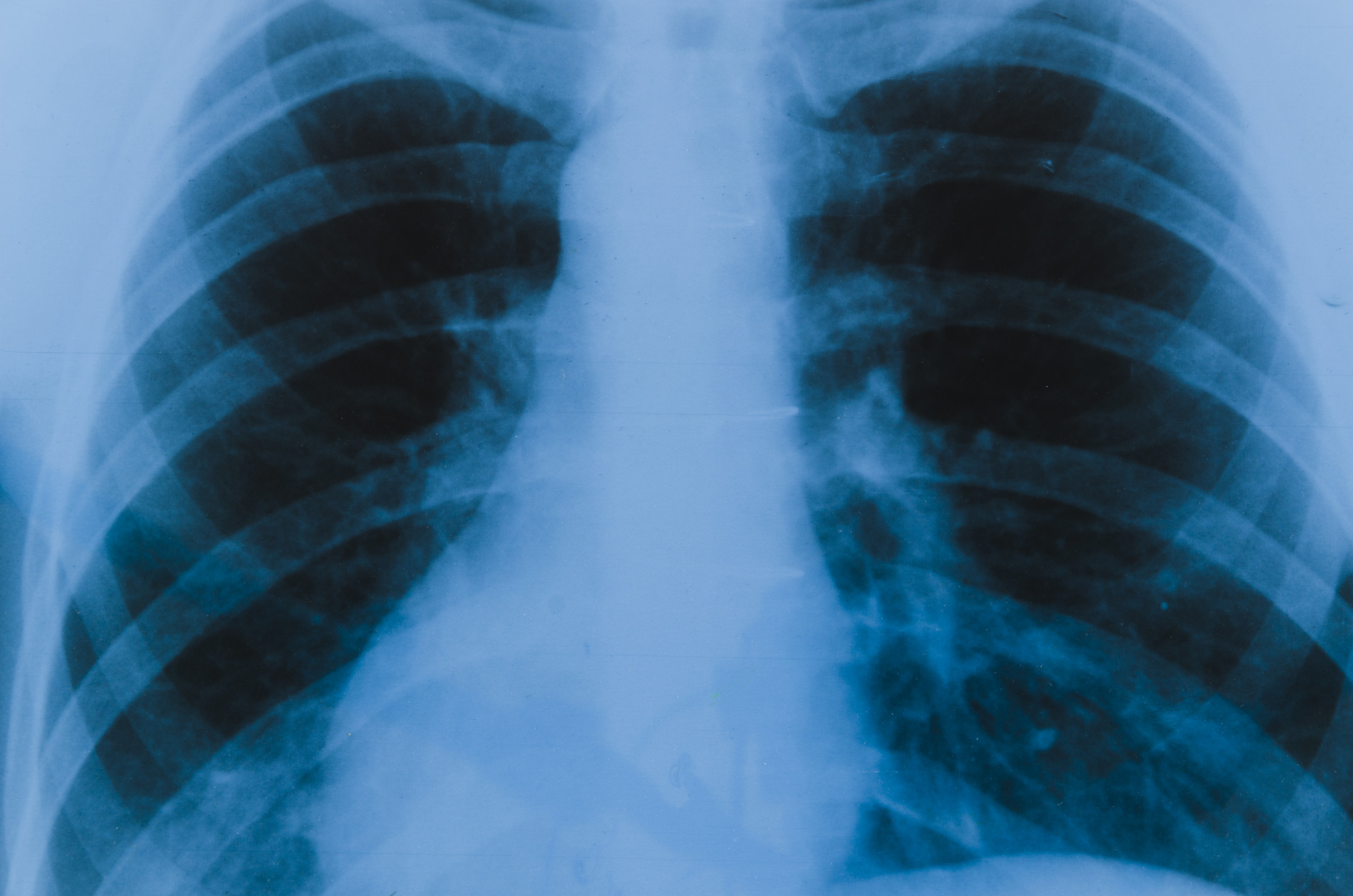 Rakovina plic zůstává dlouho nepoznaná - ONLINE... | Léčba rakoviny